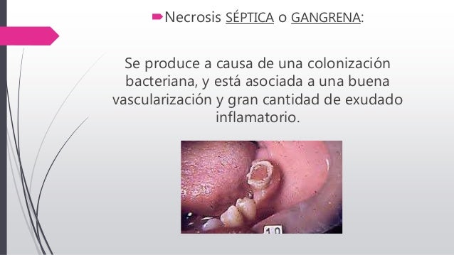 Recubrimiento, necrosis pulpar.