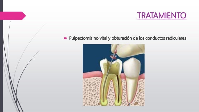 Recubrimiento, necrosis pulpar.