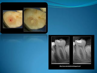 RECUBRIMIENTO PULPAR | PPTX