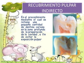 Recubrimiento pulpar indirecto | PPTX