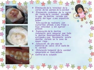 Recubrimiento pulpar indirecto | PPTX