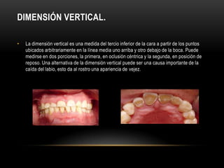Recuperación de la dimensión vertical | PPTX