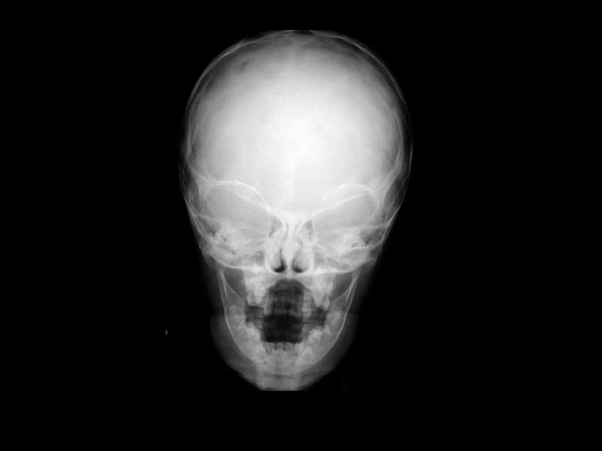 Recurrence of synostosis following surgery for isolated sagittal ...