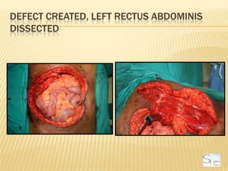Recurrent abdominal wall desmoid – rectus muscle transposition | PPTX ...