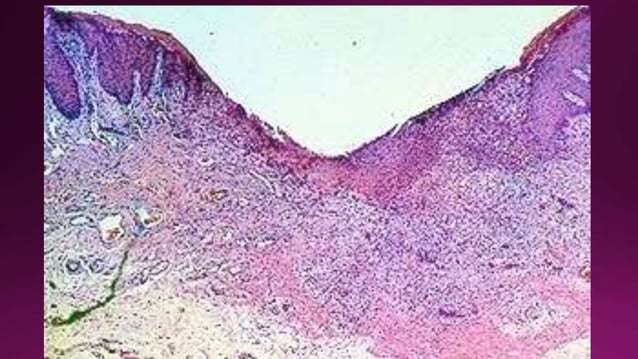 Recurrent aphthous stomatitis | PPTX