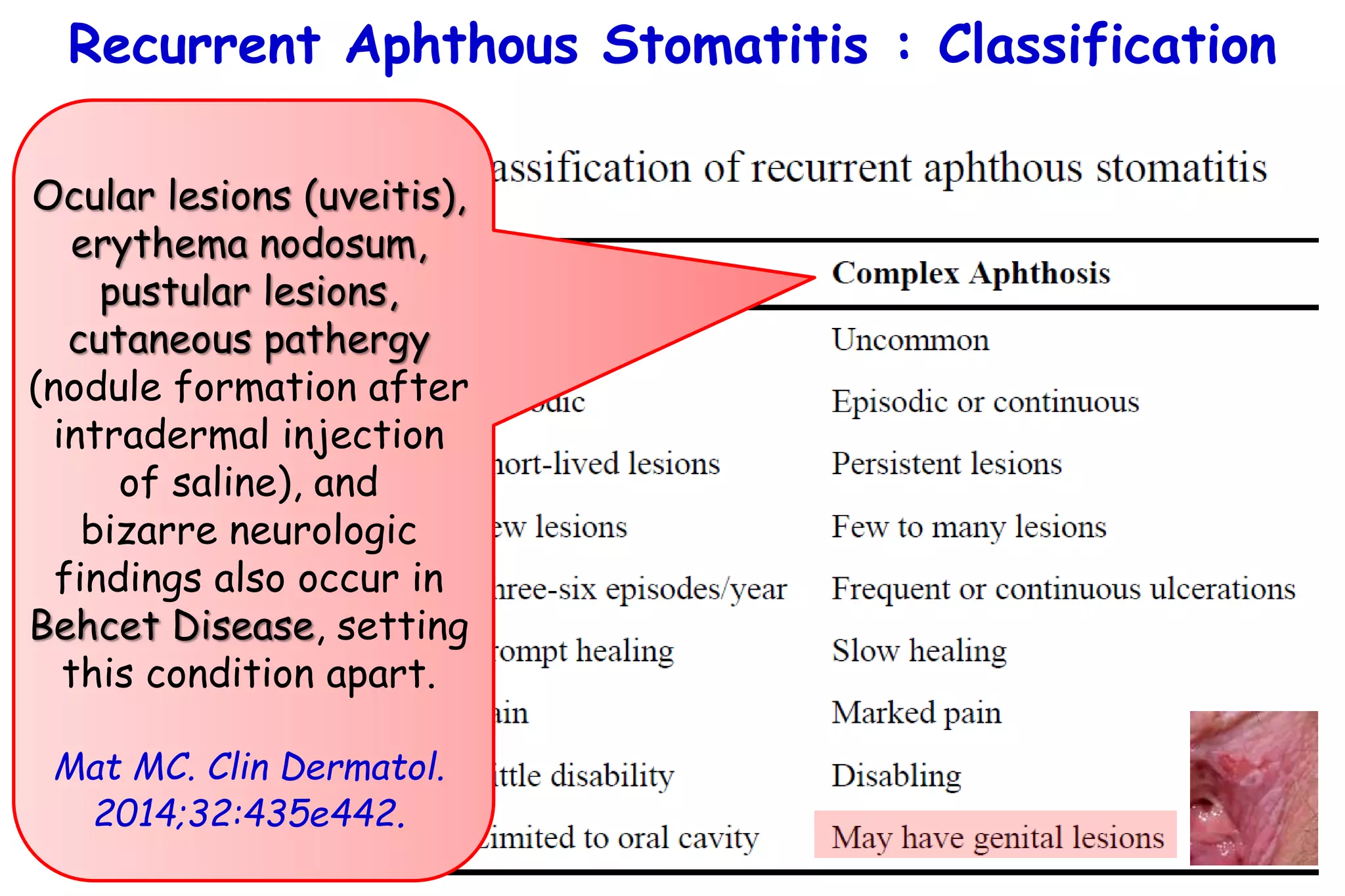 Recurrent aphthous stomatitis | PPTX