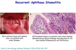 Aphthous Stomatitis Histology