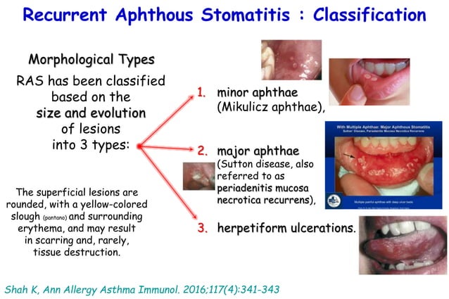Recurrent aphthous stomatitis | PPT