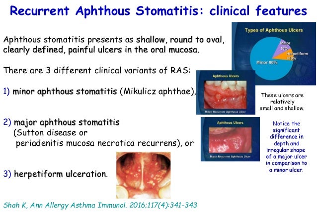 Recurrent aphthous stomatitis