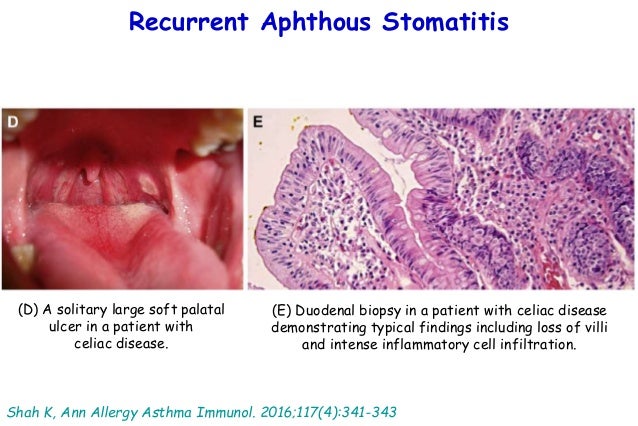 Recurrent aphthous stomatitis