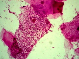 Scientific Sessions 2015: Recurrent BV and candidiasis | PPTX | Sexual ...