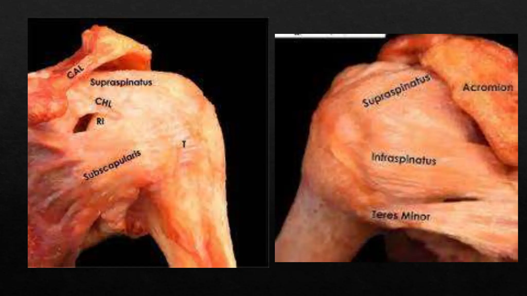 Recurrent Dislocation of Shoulder.pptx