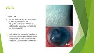 Recurrent Epithelial Erosion.pptx ophthalmology | PPT