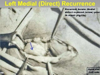 Recurrent Inguinal Hernia Pathological Types - Sanjoy Sanyal | PPTX