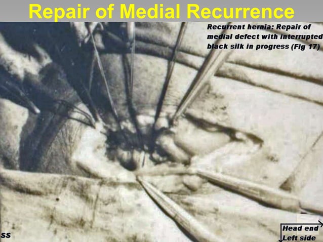 Recurrent Inguinal Hernia Pathological Types - Sanjoy Sanyal | PPTX
