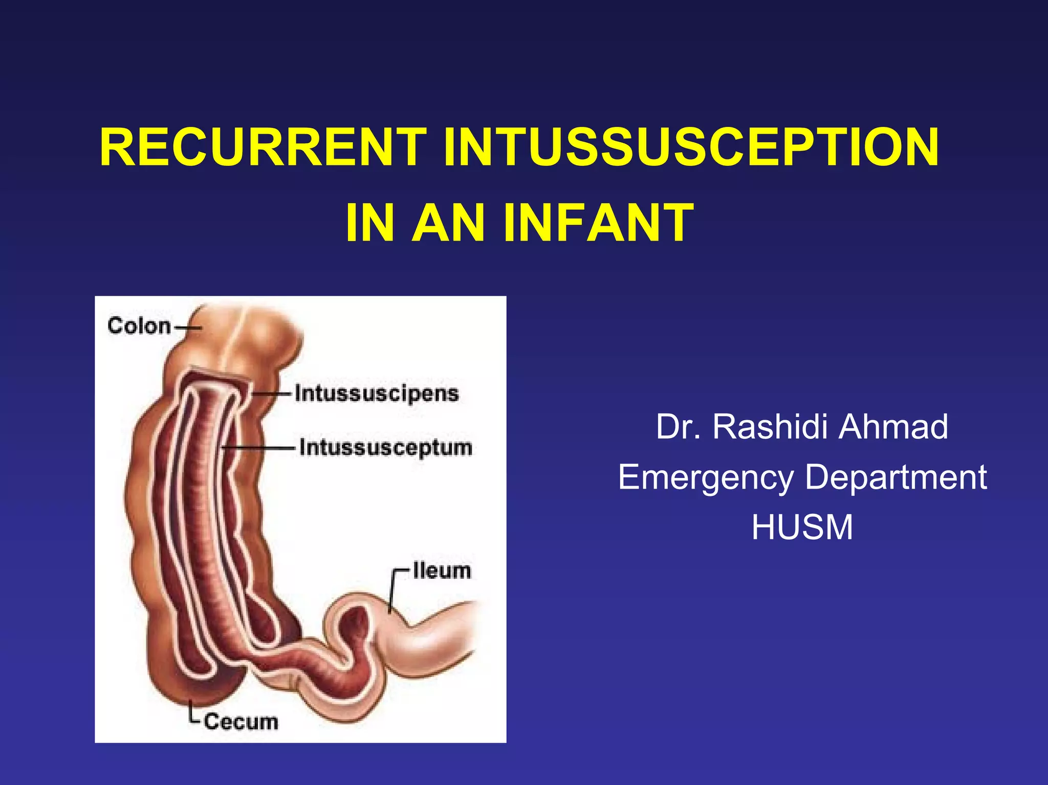 Recurrent Intussusception | PDF