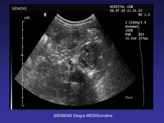 Recurrent Intussusception | PDF