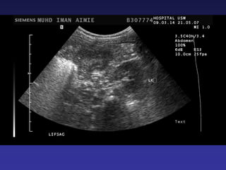 Recurrent Intussusception | PDF