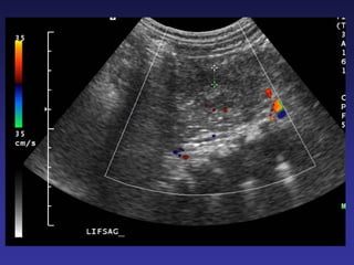 Recurrent Intussusception | PDF