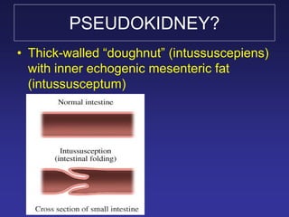Recurrent Intussusception | PDF