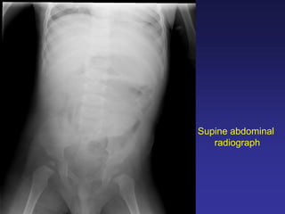 Recurrent Intussusception | PDF