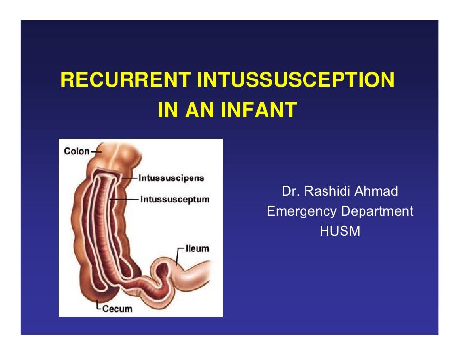 Recurrent Intussusception