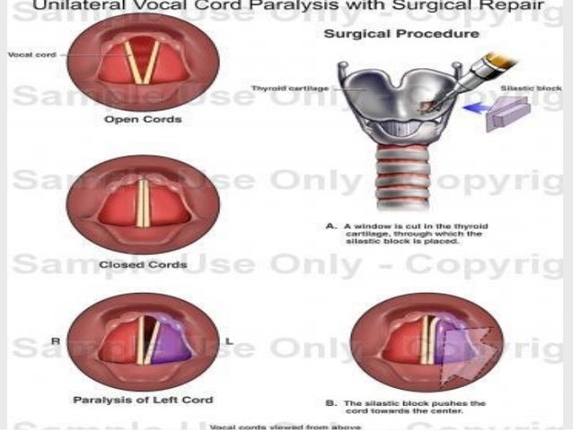 Recurrent laryngeal nerve paralysis