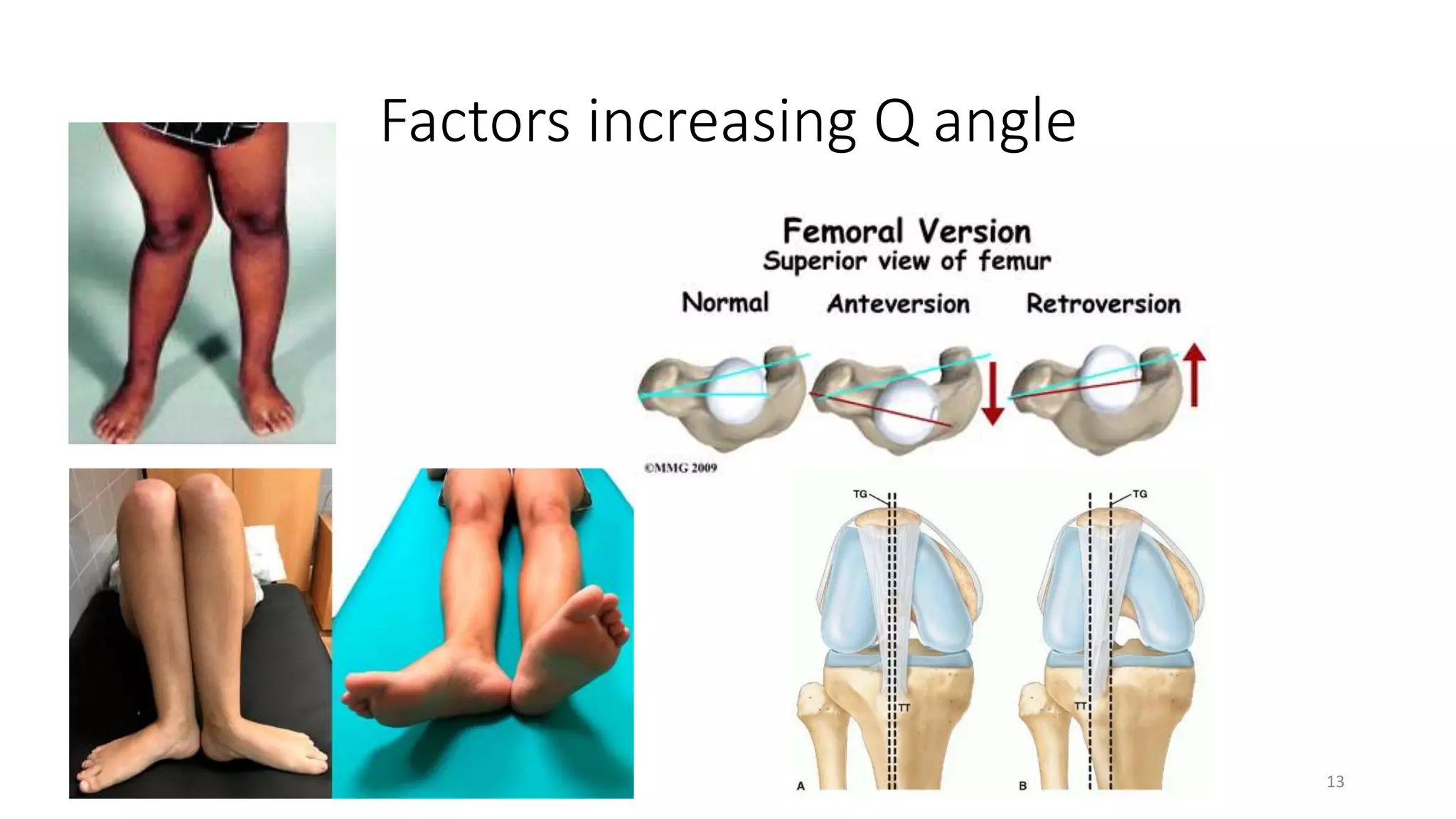 Recurrent Dislocation of patella | PPTX
