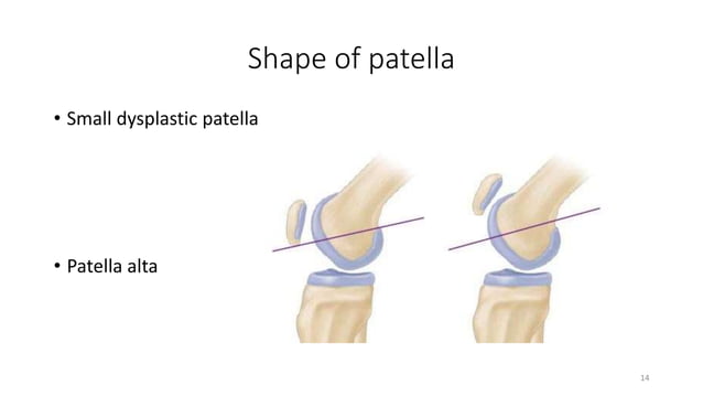 Recurrent Dislocation of patella | PPTX