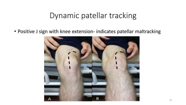 Recurrent Dislocation of patella | PPTX