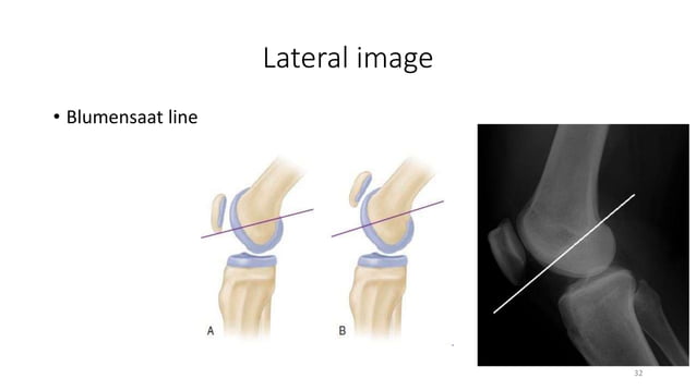 Recurrent Dislocation of patella | PPTX
