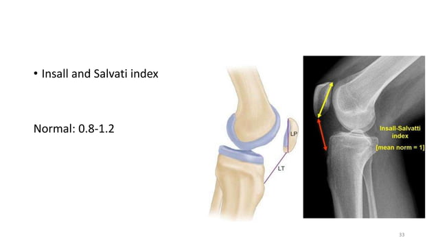 Recurrent Dislocation of patella | PPTX