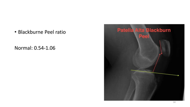 Recurrent Dislocation of patella | PPTX