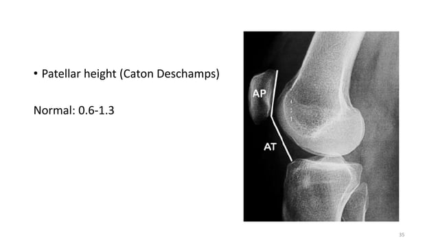 Recurrent Dislocation of patella | PPTX