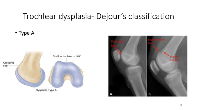 Recurrent Dislocation of patella | PPTX