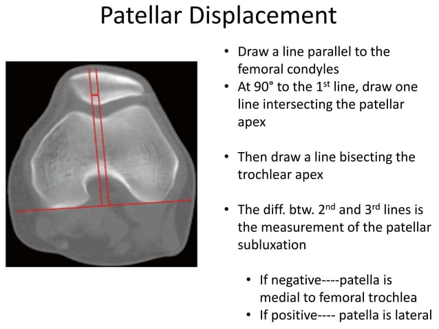 Recurrent patellar dislocation | PPT