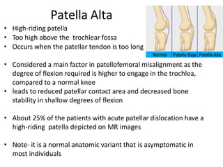 Recurrent patellar dislocation | PPT