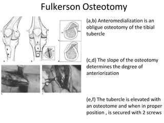 Recurrent patellar dislocation | PPT