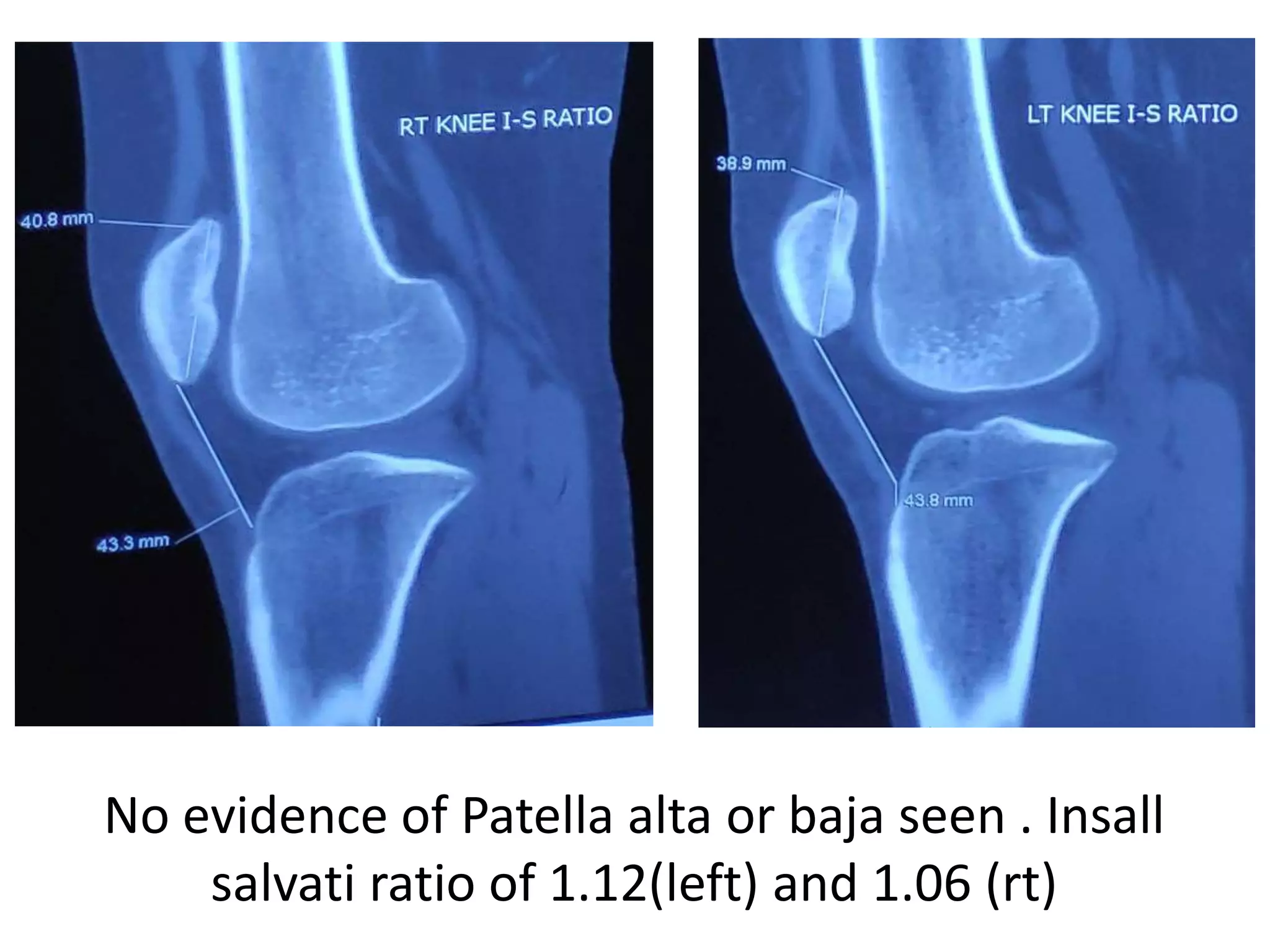 Recurrent Patellar Instability | PPTX
