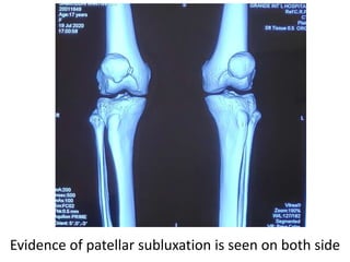Recurrent Patellar Instability | PPTX