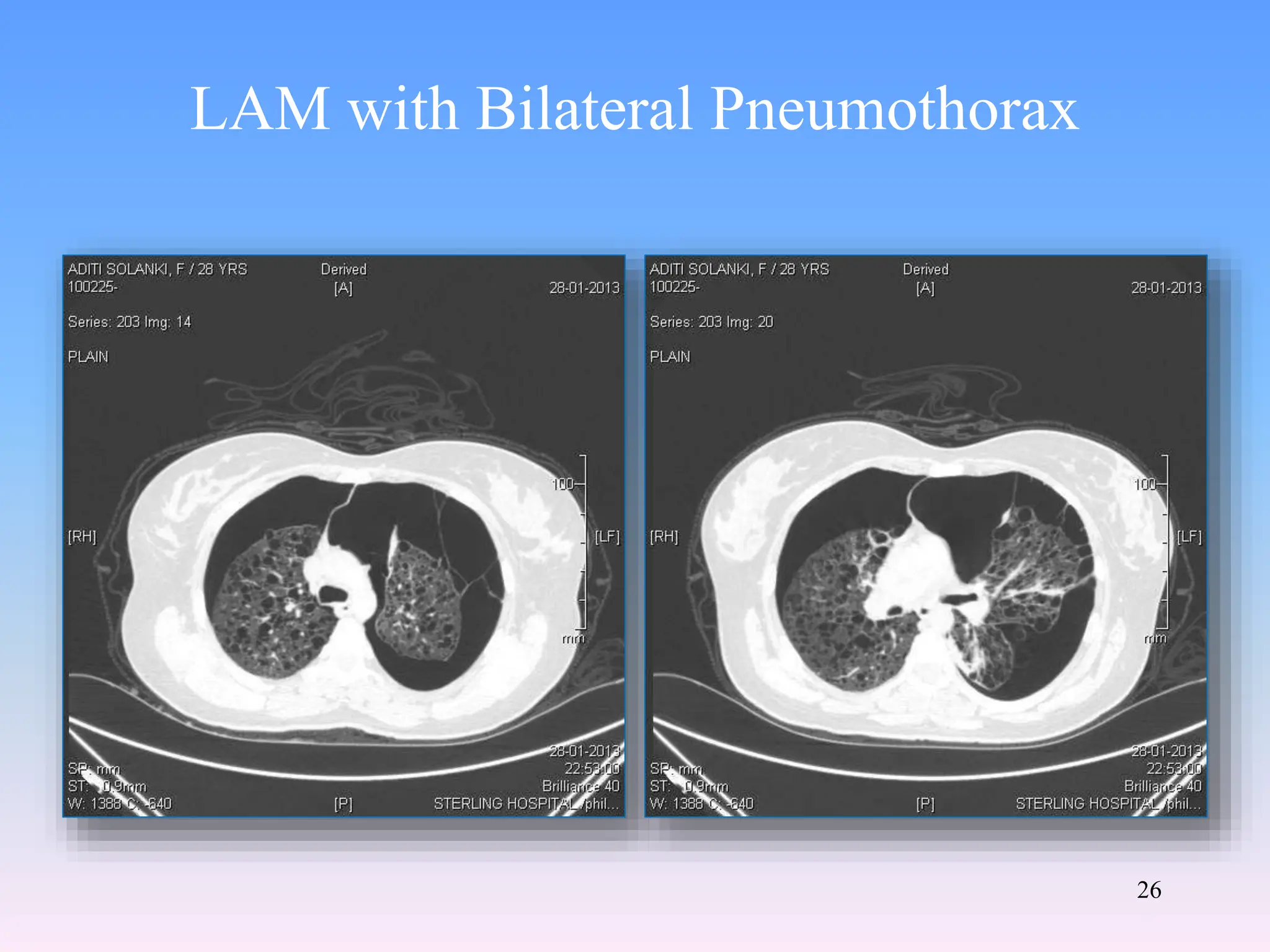 Recurrent Pneumothorax and Pleural Effusion Role of Pleuroscopy ...