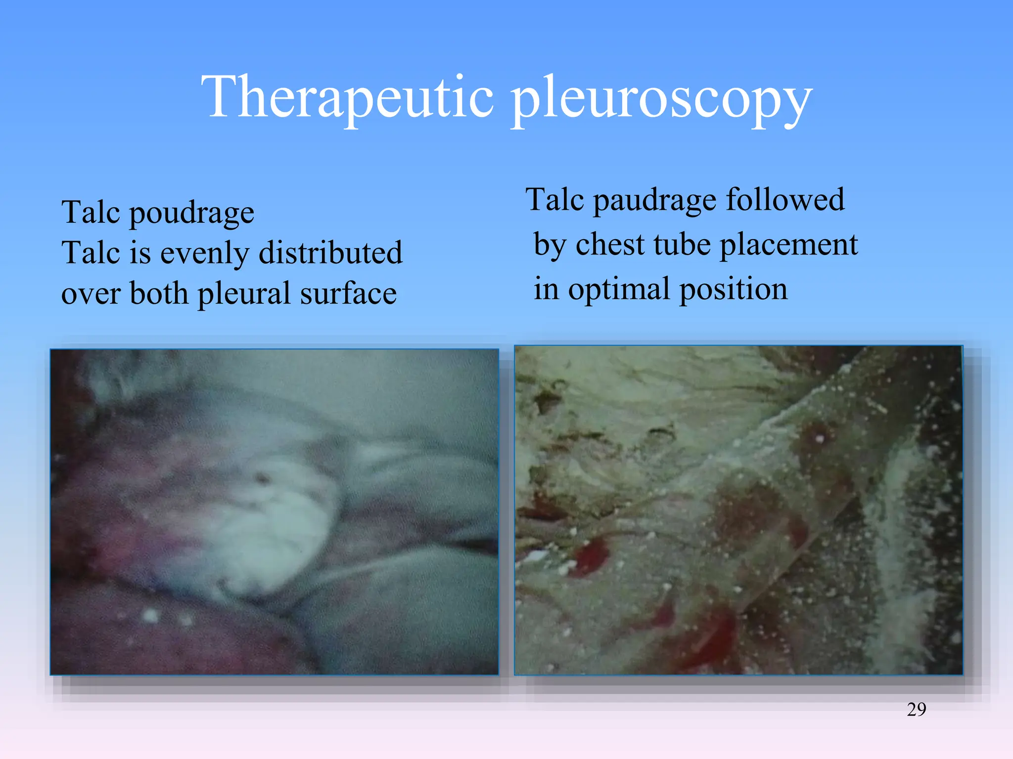 Recurrent Pneumothorax and Pleural Effusion Role of Pleuroscopy ...