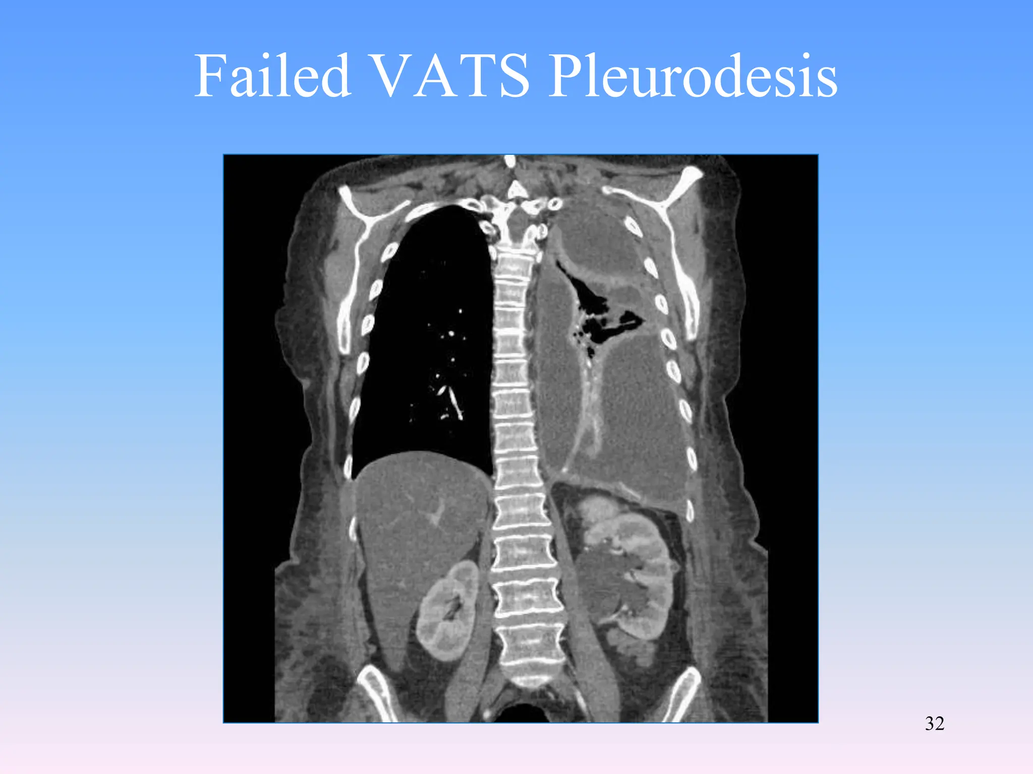 Recurrent Pneumothorax and Pleural Effusion Role of Pleuroscopy ...