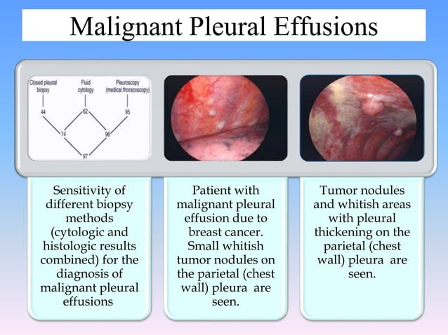 Recurrent Pneumothorax and Pleural Effusion Role of Pleuroscopy ...