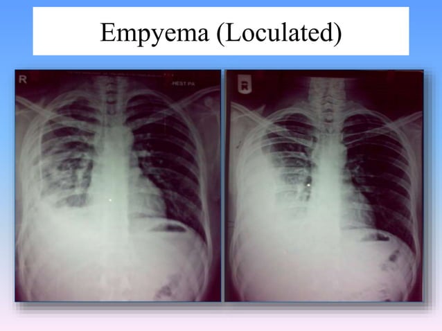 Recurrent Pneumothorax and Pleural Effusion Role of Pleuroscopy ...