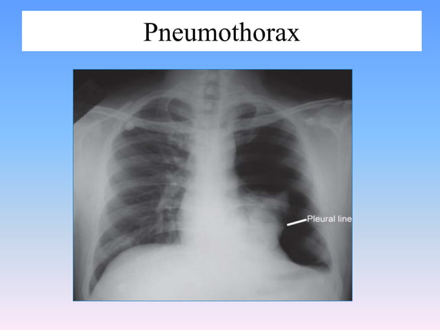 Recurrent Pneumothorax and Pleural Effusion Role of Pleuroscopy ...