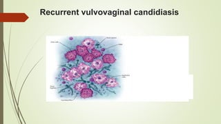 Recurrent pv discharge | PPTX