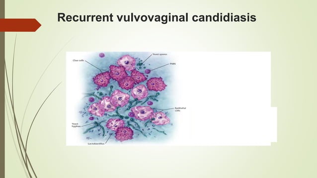 Recurrent pv discharge | PPTX