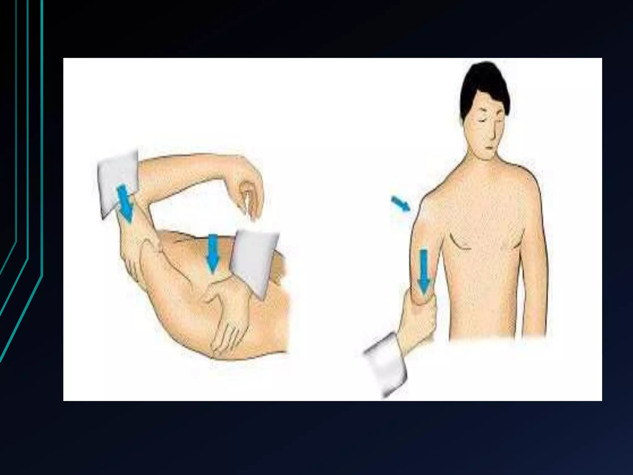 Recurrent shoulder dislocation | PPTX