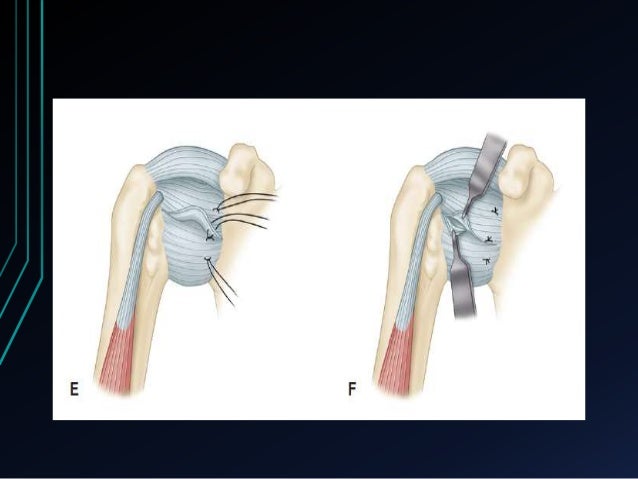 Recurrent shoulder dislocation